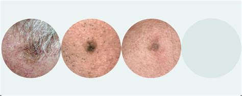 Early Stage Melanoma Pictures