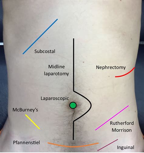 Laparotomy Scar