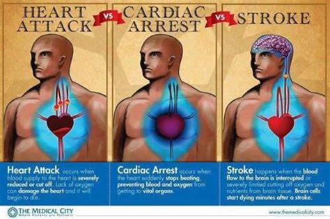 Heart Attack Vs Cardiac Arrest Vs Stroke Health Blog Centre Info