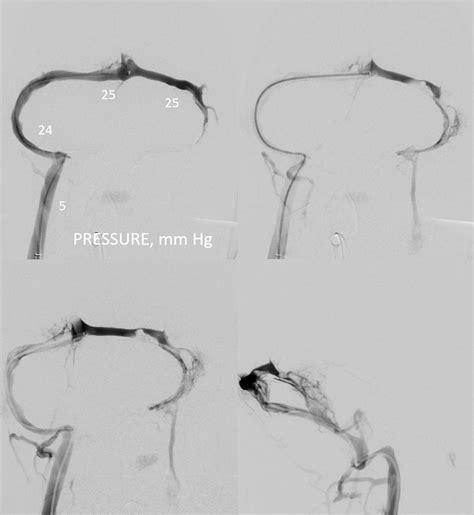 Venous Sinus Thrombosis Mastoiditis Delayed Complications Intracranial