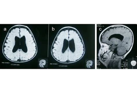 Neonatal And Infant Brain Imaging Evaluation