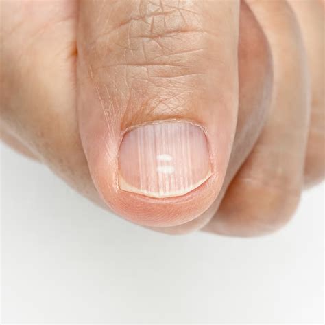Understanding The Real Causes Of Vertical Ridges On Your Nails Wake