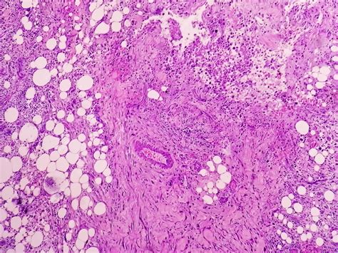 Premium Photo Photomicrograph Of Breast Abscess Granulomatous