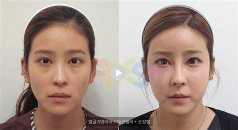 Natural Korean Nose