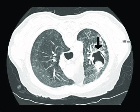 Ct Scan Of The Chest Showed The Mass Within The Cavity Moved To The