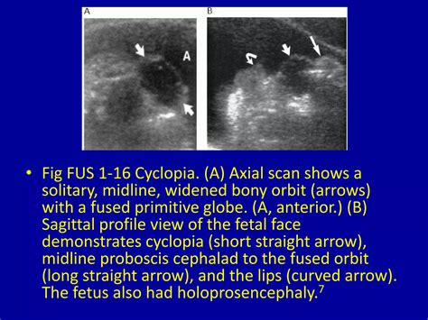 1 Ultrasound Diagnosis Of Fetal Anomalies Pptx