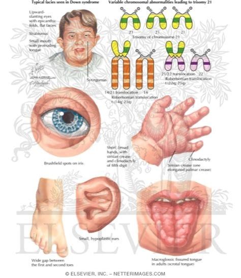 Down Syndrome Diagram