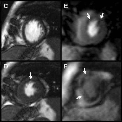 Cardiac Magnetic Resonance Imaging Cine Mri Dipyridamole Stress