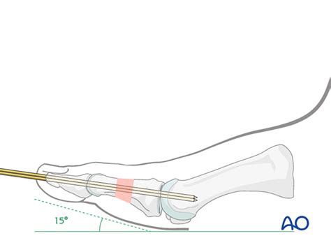 K Wire Fixation For Diaphyseal And Extraarticular End Segment Fractures Of The Proximal Hallux