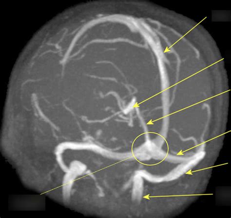 Medical Imaging Mr Venogram Oblique View Diagram Quizlet