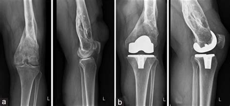 Knock Knees Angular Deformity Of Knee Surgical Program