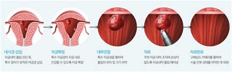 생리는 자궁건강의 지표용종과 점막하근종 자궁경 시술로 동시 치료 가능