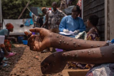 Africa Faces Acute Mpox Outbreak As Cases Surpass 50000 New Vision