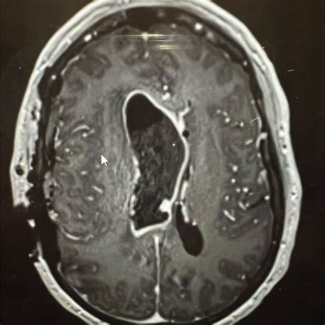 Axial T1 W Post Contrast Image Of A Polymicrobial Intraventricular