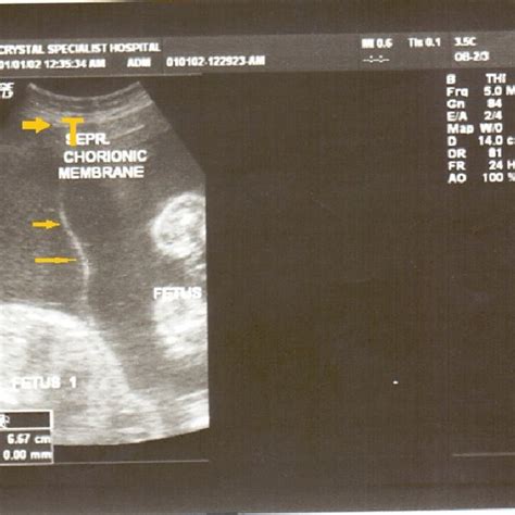 Pdf Morphological Progression Of Chorionic Membrane Development In Monochorionic And