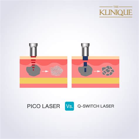 เลเซอร์หน้าใสด้วย Pico Clear Enlighten Fx ต้องยิงหน้าแดงเลือดสาดไหม