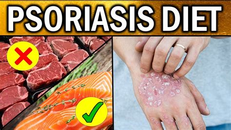 5 Best And Worst Foods For Psoriasis Psoriasis Treatment And Diet