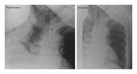 A Portable Upright Chest Radiography Showing Blunting Of The Right