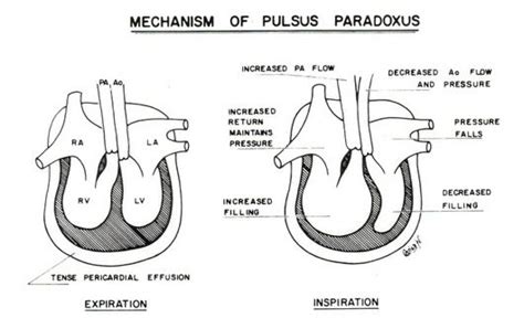 What Is Meant My Pulsus Paradoxus A One Stop Pathophysiology Thread