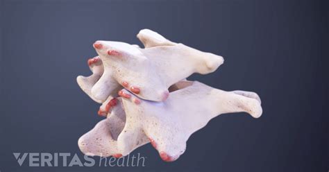 Cervical Bone Spurs Symptoms And Causes Animation