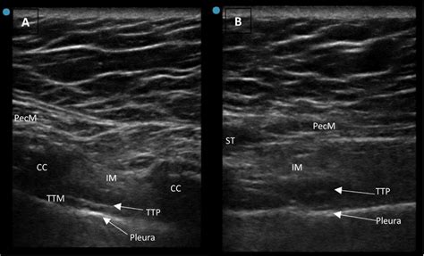 Transversus Thoracis Plane Block A Parasagittal Probe Position Download Scientific Diagram