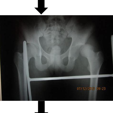 Top Pelvic Radiograph Of A Chronically Dislocated Hip At Presentation Download Scientific