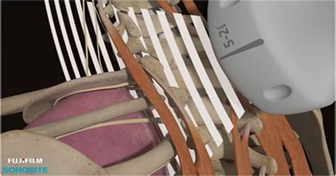 Erector Spinae Plane Block Sonosite Institute For Point Of Care Ultrasound