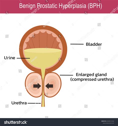Benign Prostatic Hyperplasia Bph Vector Stock Vector Royalty Free