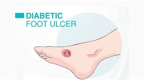 Diabetic Foot Ulcers Causes Symptoms And Treatment