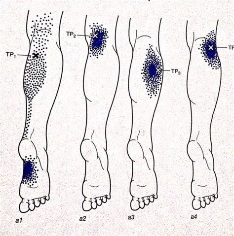 KNEE Trigger Points Flashcards Quizlet