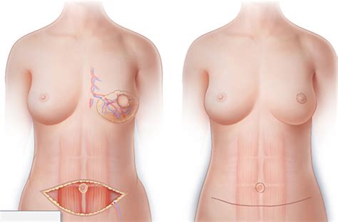Flap Procedures In Perforator Flap Reconstruction