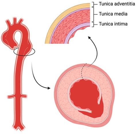 Aortic Dissection Encyclopedia Mdpi