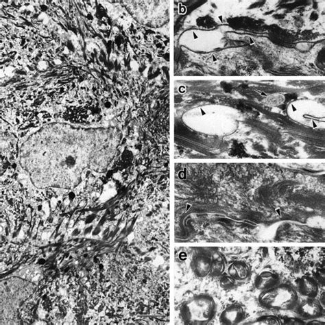 Pdf Abnormal Cornified Cell Envelope Formation In Mutilating Palmoplantar Keratoderma Pdf Abnormal Cornified Cell Envelope Formation In Mutilating Palmoplantar Keratoderma