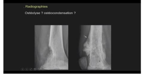 S Miologie Radiologique Des To Et Pathologies Osseuses Cartes Quizlet