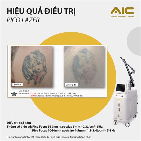Mọi thứ bạn cần biết về công nghệ Pico laser The AIC Nhà cung cấp hàng đầu các sản phẩm Y tế