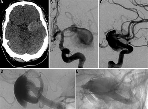 Recurrence Of A Large Intracranial Fusiform Aneurysm Treated With Overlapping Pipeline