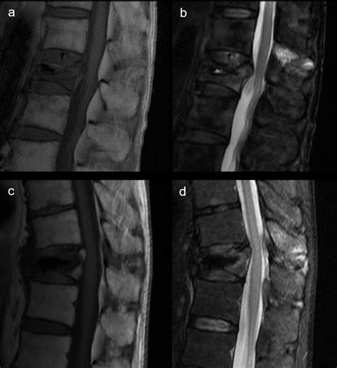 Lumbar Spinous Process Fracture