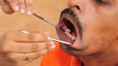 Us Says Too Much Fluoride Causing Splotchy Teeth The Hindu