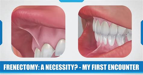 Labial Frenectomy Before And After Frenectomy Procedure