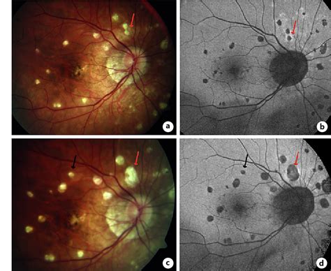 Idiopathic Multifocal Choroiditis And Punctate Inner Choroidopathy
