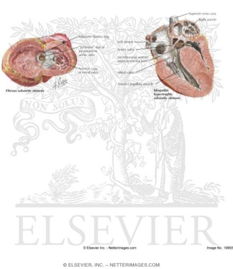 Anomalies Of The Left Ventricular Outflow Tract