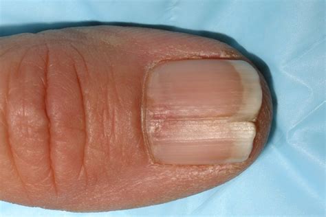 Why Do My Nails Have Ridges And Split At Anna Mcbride Blog