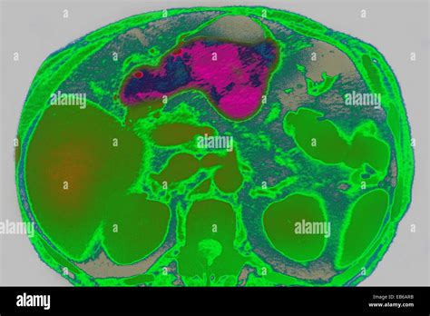 STOMACH CANCER CT SCAN Stock Photo Alamy