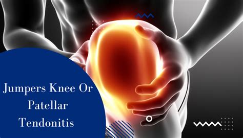 Jumpers Knee Or Patellar Tendonitis Knee Surgeon Dubai