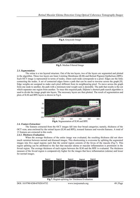 retinal macular edema detection using optical coherence tomography