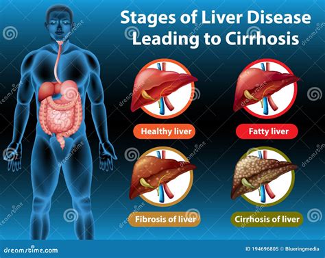 Liver Cirrhosis Nursing Care Plan Managementdocx Liver