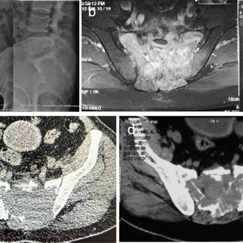 Preoperative Radiographic Examinations A B Preoperative X Ray And Mri
