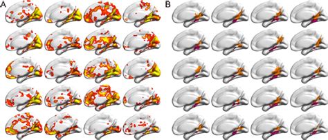 Sample Activations And Delineated Ssrs In The Right Hemispheres From