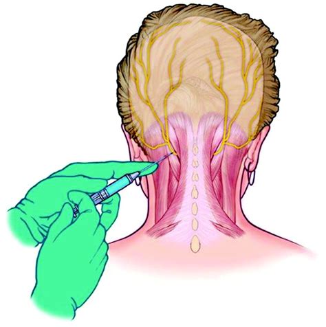 Cpt Code Occipital Nerve Block At Marcos Hines Blog