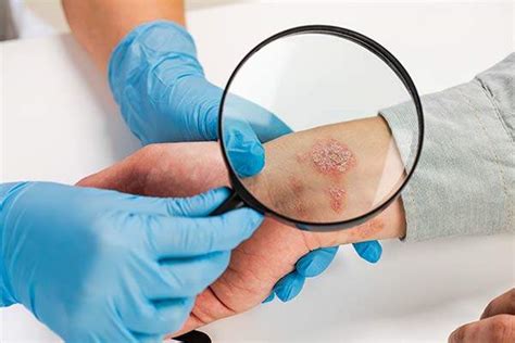 Ayurvedic Fungal Infections Treatment Cost In Cippenham Berkshire